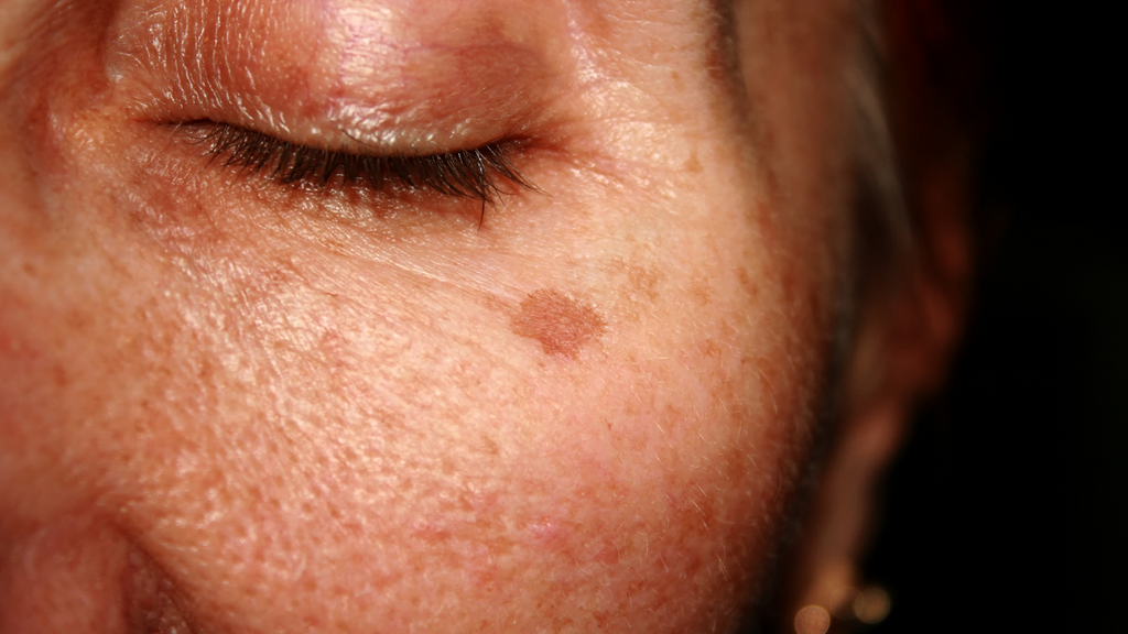 Hyperpigmentation : comment venir à bout des tâches brunes ? – Reborn
